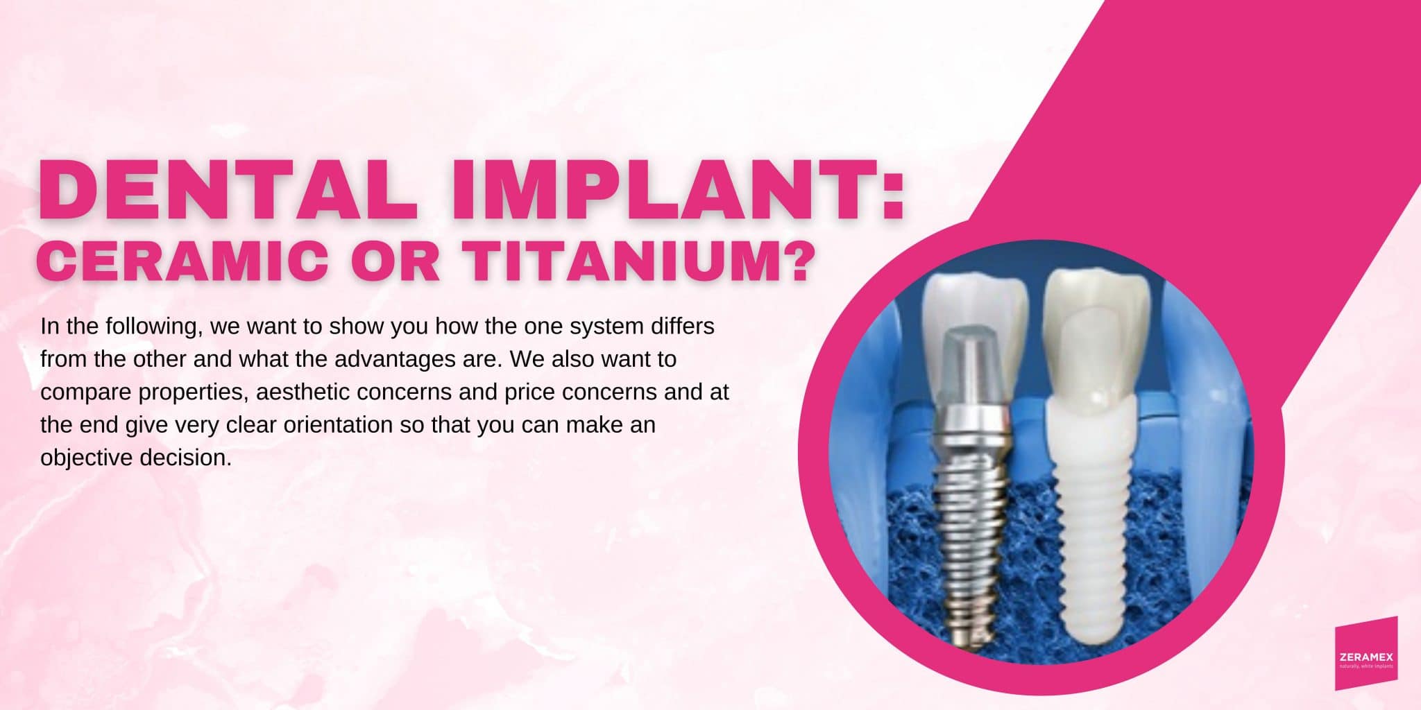 Dental implant: Ceramic or Titanium? - Zeramex USA