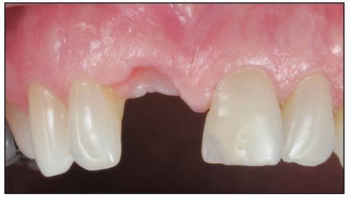 Why would you use a silver color in the front teeth of someone's mouth ...