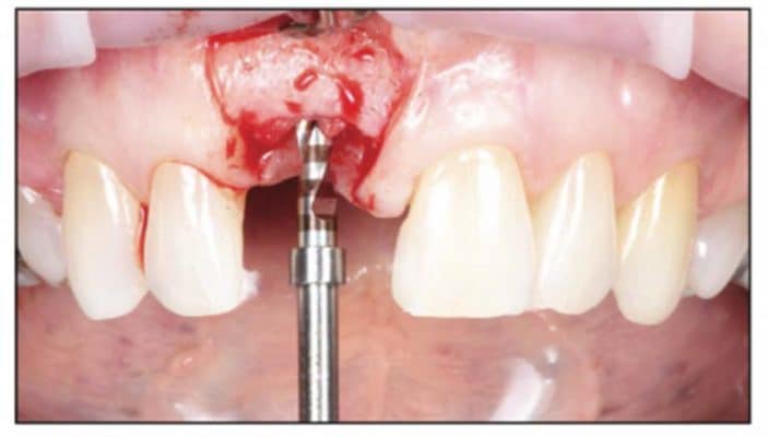 Why would you use a silver color in the front teeth of someone's mouth ...