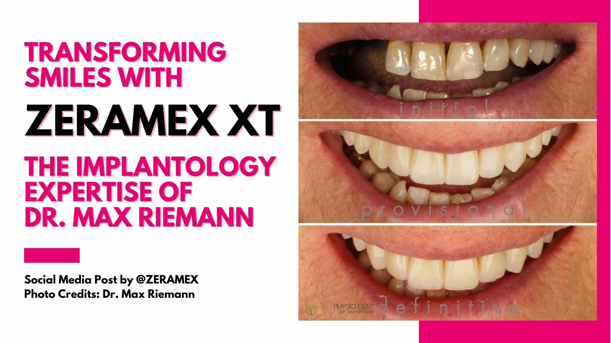 Transforming Smiles with ZERAMEX XT The Implantology Expertise of Dr ...