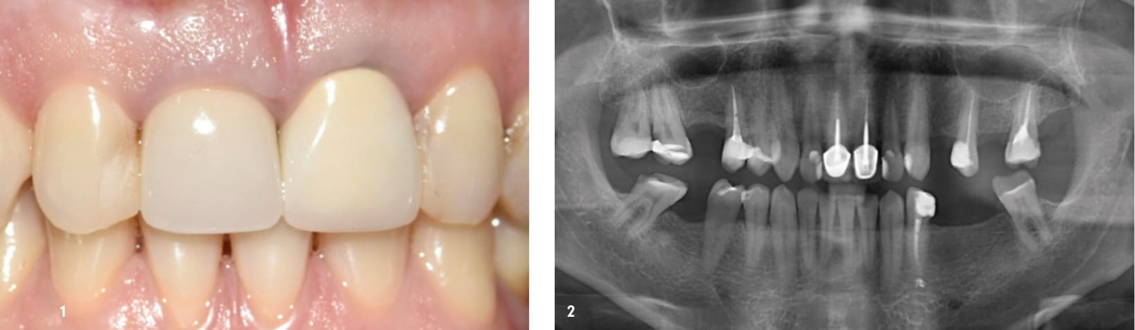 Front and Center: Enhancing Smiles with ZERAMEX Two-Piece Zirconia ...